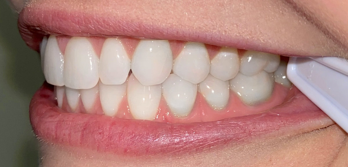 Virtual Smile Assessment - Farnsworth Family Orthodontics
