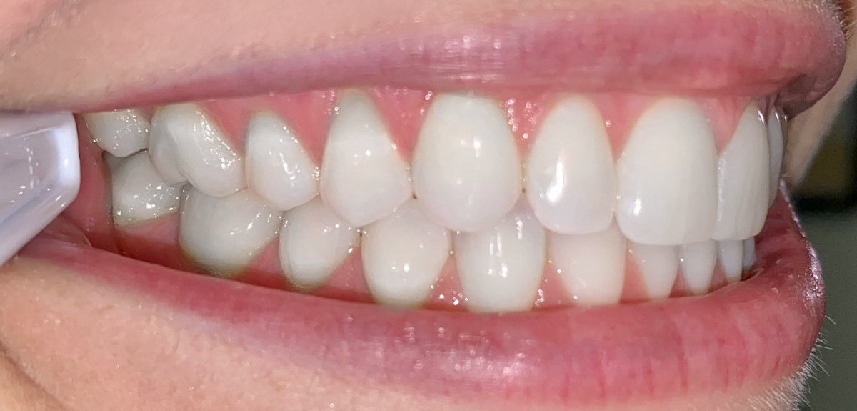 Virtual Smile Assessment - Farnsworth Family Orthodontics